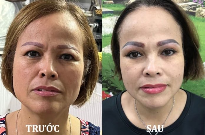 Bỏ Túi Top 9 Cơ Sở Tiêm Filler Botox Hải Phòng Giá Rẻ Nhất